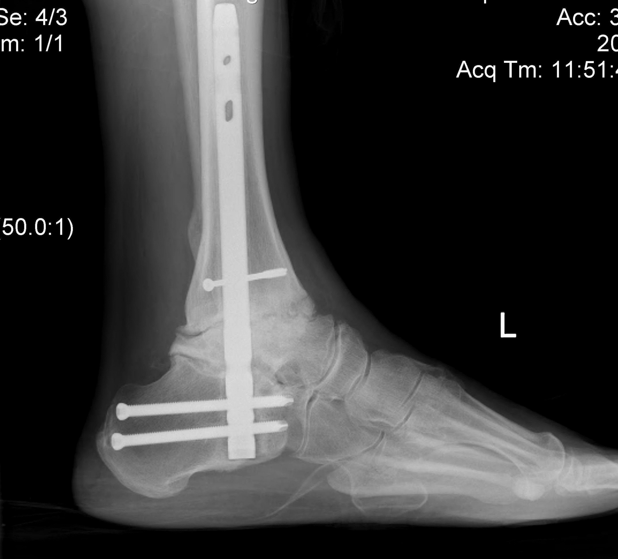 Ankle Arthritis - Riverina Orthopaedics
